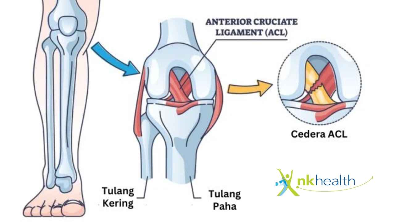 Berapa Lama Fase Penyembuhan Pasca Operasi Cedera ACL?