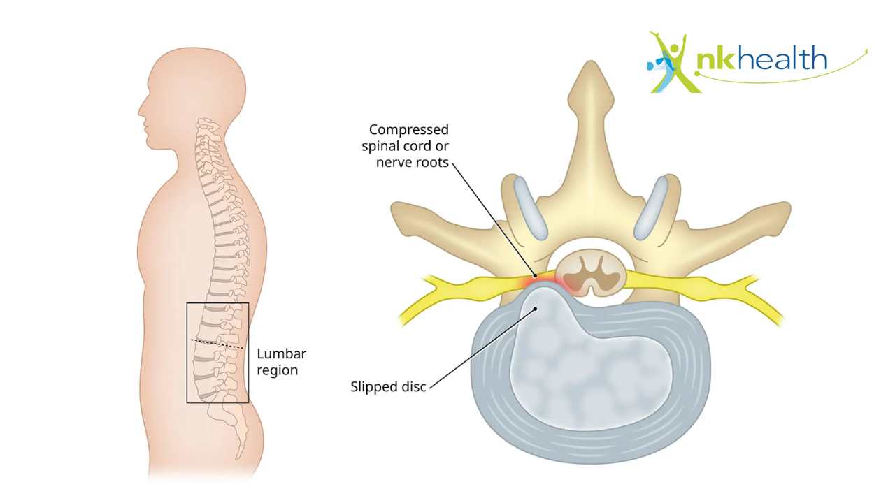 Penyebab Nyeri Saraf Sciatica dan Cara Mengobatinya